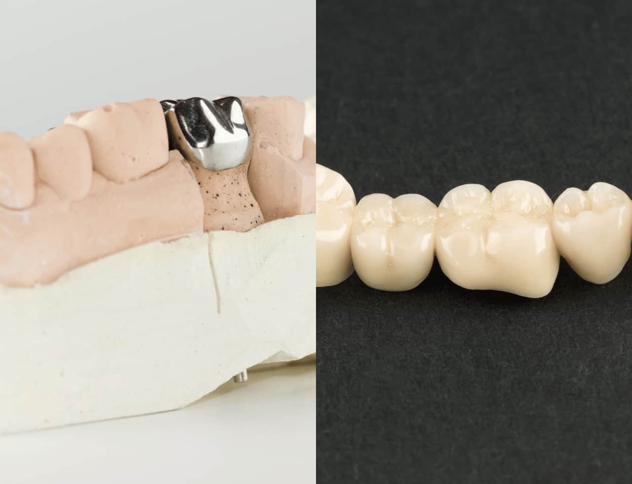 Implant Crowns & Bridges - Smilebook Dental