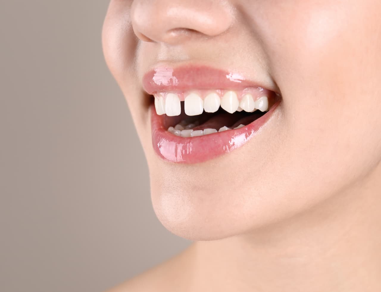 Invisalign For Gaps In Hyderabad Smilebook Dental